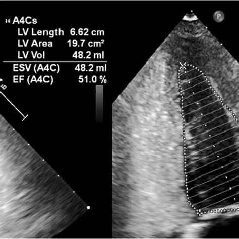 Biplane Simpsons Method For Calculation Of Left Ventricular Ejection