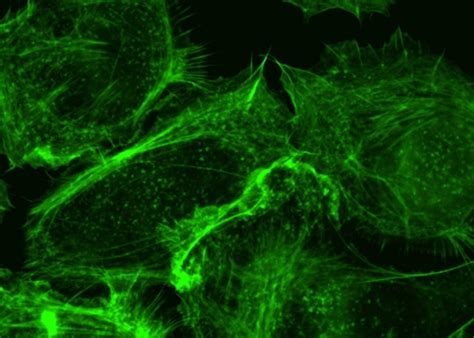 Genotyping For Hpv 1618 May Help Guide Colposcopy Referrals For Women