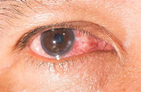 Keratitis Articles On Causes Symptoms And Treatment Options