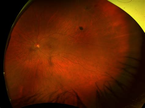 Quiz Paciente Com Buraco Operculado Da Retina Teste Seus