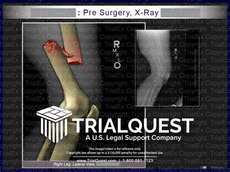 Pre Surgery X Ray Trialquest Inc