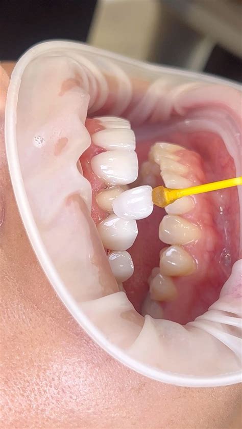 Minimal Prep Veneers [video] Healthy Teeth Teeth Whitening Implant