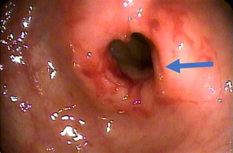 Colonoscopy With Balloon Dilation Maher A Abbas Md Dubaiuae