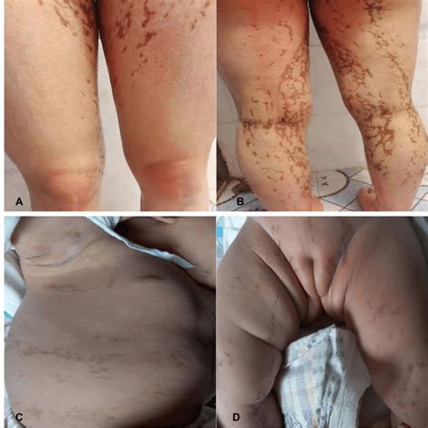 Clinical Features A And B Brownish Linear And Whorled Download
