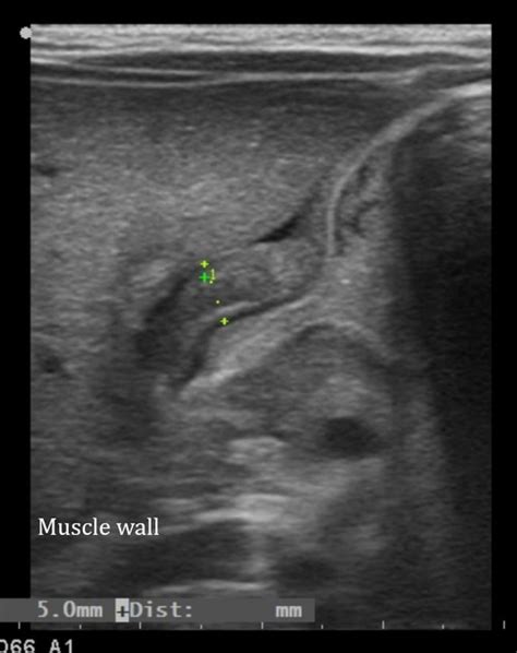 Infantile Hypertrophic Pyloric Stenosis Image Radiopaediaorg