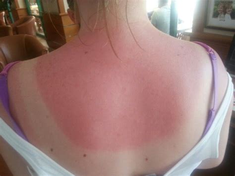 Sun Burn Sunburn Peeling Sunburn Remedies Peeling Skin