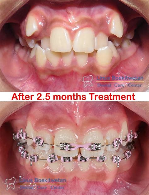 Braces Lavender At Georgia Challis Blog