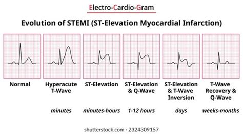 Abnormal T Wave Morphology