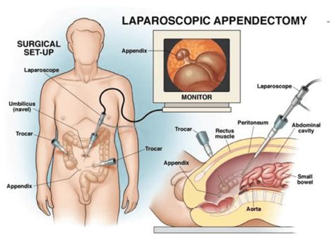 Laparoscopic Appendix Removal Appendectomy Surgery Patient Information