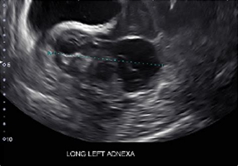 Figure 1 Transabdominal Ultrasound In Long Left Adnexa View Showing