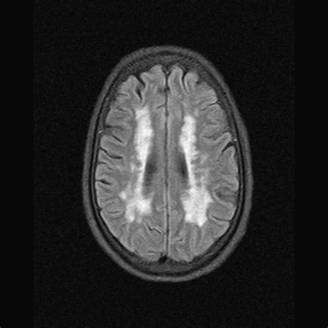 Radiopaedia Case Binswanger Disease Subcortical Arteriosclerotic