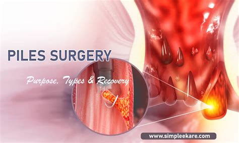Surgical Treatment For Piles Different Procedures And Recovery Process