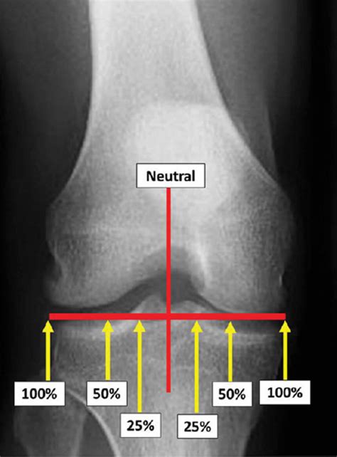 Microfracture Surgery Indications Recovery And Success Rate