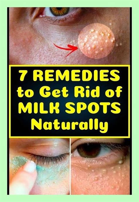Milia How To Remove Remedies Natural Remedies Whiter Skin