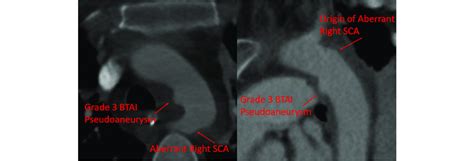 Axial And Sagittal Computed Tomography Angiography Cta Of The Aortic