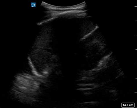 No Pleural Effusion Archives Global Ultrasound Institute