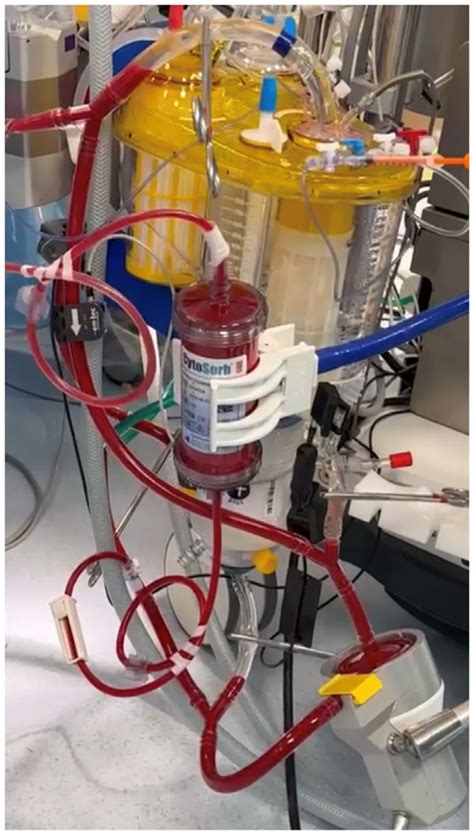 Intraoperative Photograph Showing The Cytosorb Cartridge Integrated