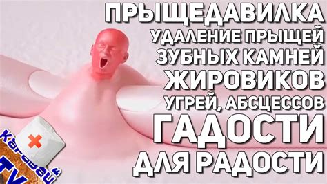 КАРАВАЙTV / ПРЫЩЕДАВИЛКА / УДАЛЕНИЕ ПРЫЩЕЙ, ЗУБНЫХ КАМНЕЙ, УГРЕЙ ...