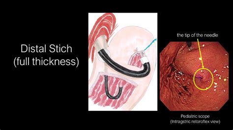 Endoscopic Fundoplication Gerd At Inez Bennett Blog