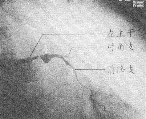 瘤样”扩张 冠状动脉造影
