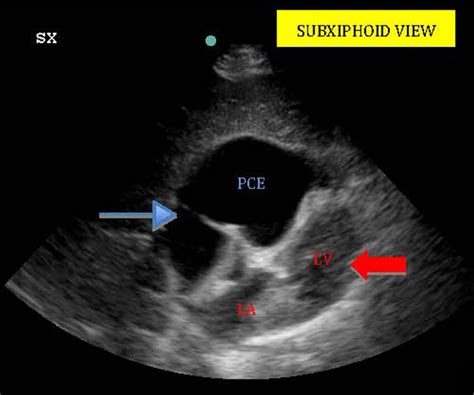 Figure Bedside Echocardiogram Subxiphoid View Sx Of Heart