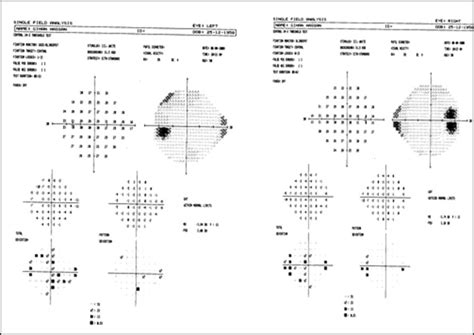Which Is And Nasal Visual Field Interpretation