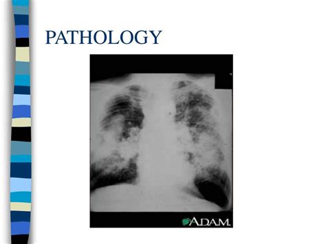 Ppt Radiographic Artifacts Powerpoint Presentation Free Download