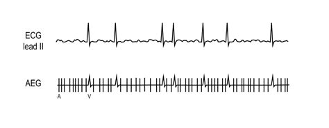 Atrial Fibrillation Af Atrial Electrogram Education Uwmadison