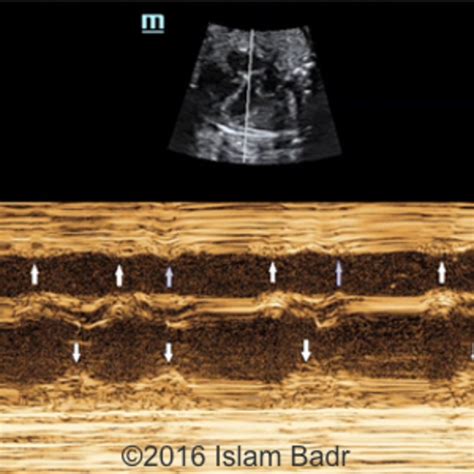 Can Caffeine Cause Premature Atrial Contractions At Leo Brodbeck Blog