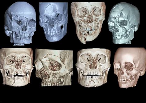 Facial Fracture Treatment In Delhi Facial Bone Fracture