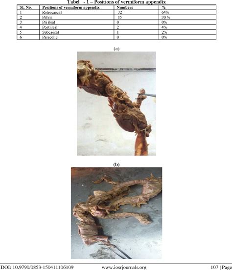 Appendix Location Variation