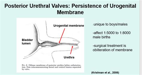 Posterior Urethral Valves Diagram