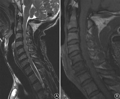 Feasibility And Safety Of Cervical Kinematic Magnetic Resonance Imaging