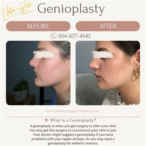 Dreberle Plasticsurgery Cellulitereduction Cosmeticprocedure Plasticsurgerybeforeandafter