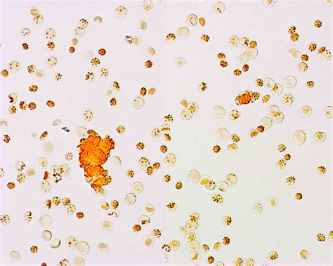 Pathology Outlines Hemolytic Disease Of The Fetus And Newborn