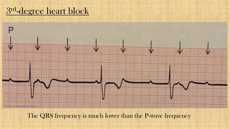 Lecture 5 Arrhythmias Part Ppt Download
