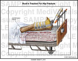 Bucks Traction For Hip Fracture Medical Illustration Medivisuals