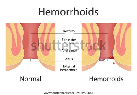 Hemorrhoids Inflammation Cause Bleeding Through Patients Stock Vector Royalty Free 2508902047