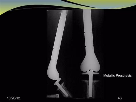Role Of Radiation In Bone Tumors For Orthopedics Ppt Cancer