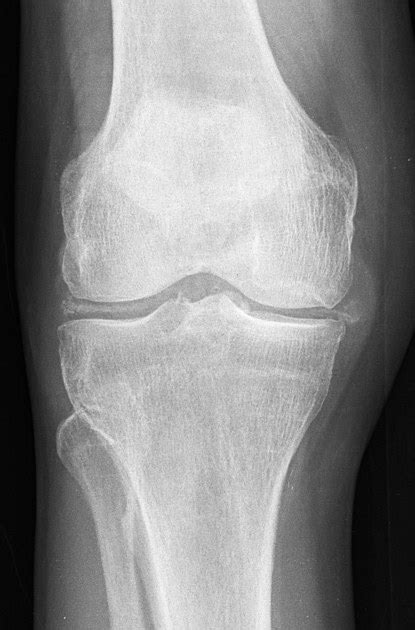 Chondrocalcinosis X Ray