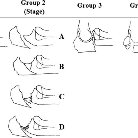 Colton Classification For Olecranon Fractures 8 Colton Proposed That Download Scientific