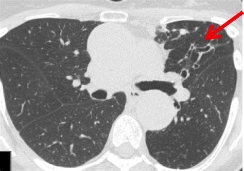 High Resolution Chest Computed Tomography Of Nodular Bronchiectasis Download Scientific Diagram