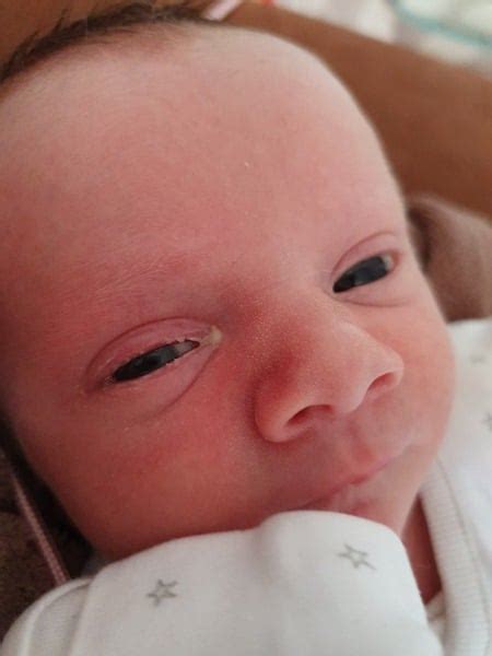 Newborn Is This Conjunctivitis Pic Attached Mumsnet