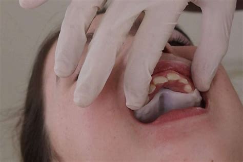The Groundbreaking Invisalign Palatal Expander A Tool That Is