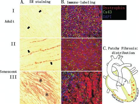 Pattern And Distribution Of Interstitial And Replacement Fibrosis Of Download Scientific
