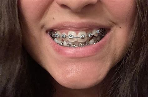 First Day Of Braces 24 Month Treatment Begins Today Wish Me Luck