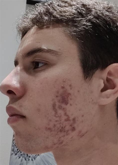 My Skin Transformation Thanks To Accutane Raccutane