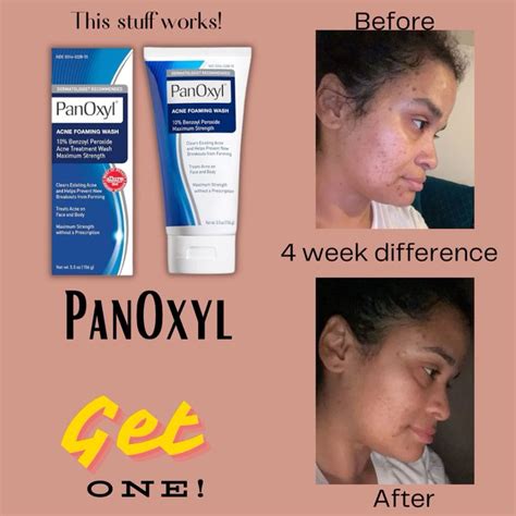 Panoxyl Acne Foaming Wash Benzoyl Peroxide 10 Maximum Strength