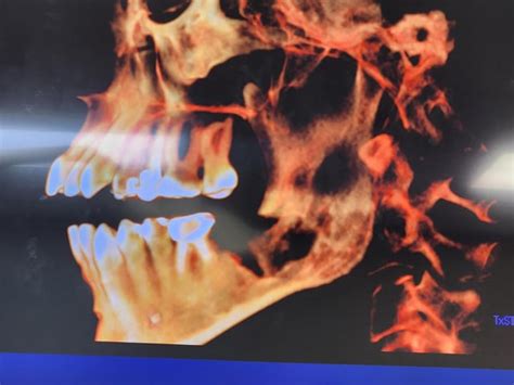 Dad Had A Root Canal And Impacted Wisdom Tooth Extracted On Friday 6 Days Ago Would It Be Too