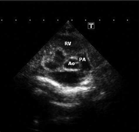 Parasternal Short Axis View Showings Anatomically Normal Right